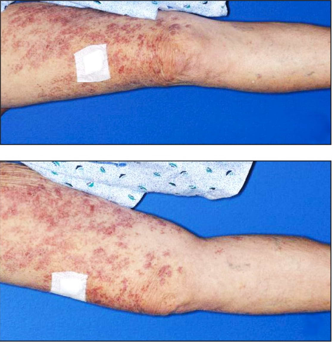 Lupus: between conditions that mimic it and those that come — Typology